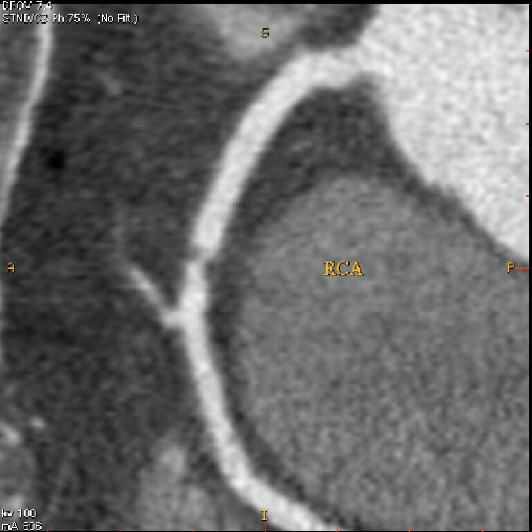 Cardiac CT Scan Procedure - Dr. Rudd Cardiology