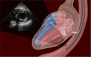 Trans(o)esophageal echocardiogram (TOE or TEE) - Dr Rudd Cardiology